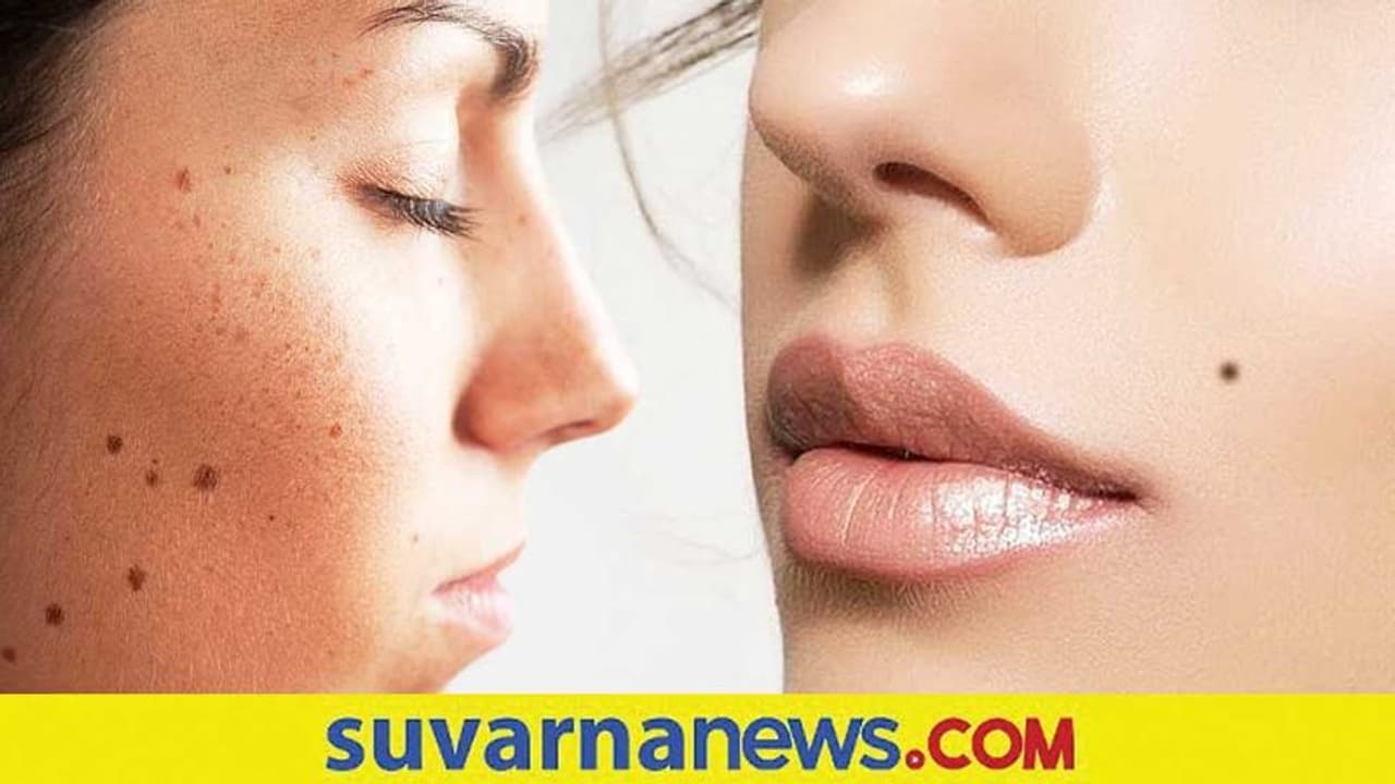 Skin and Fleck: ಬ್ಯೂಟಿ ಸ್ಪಾಟ್ ಆಯ್ತು ಕ್ಯಾನ್ಸರ್ ಸೂಚಕ | Small fleck in ...