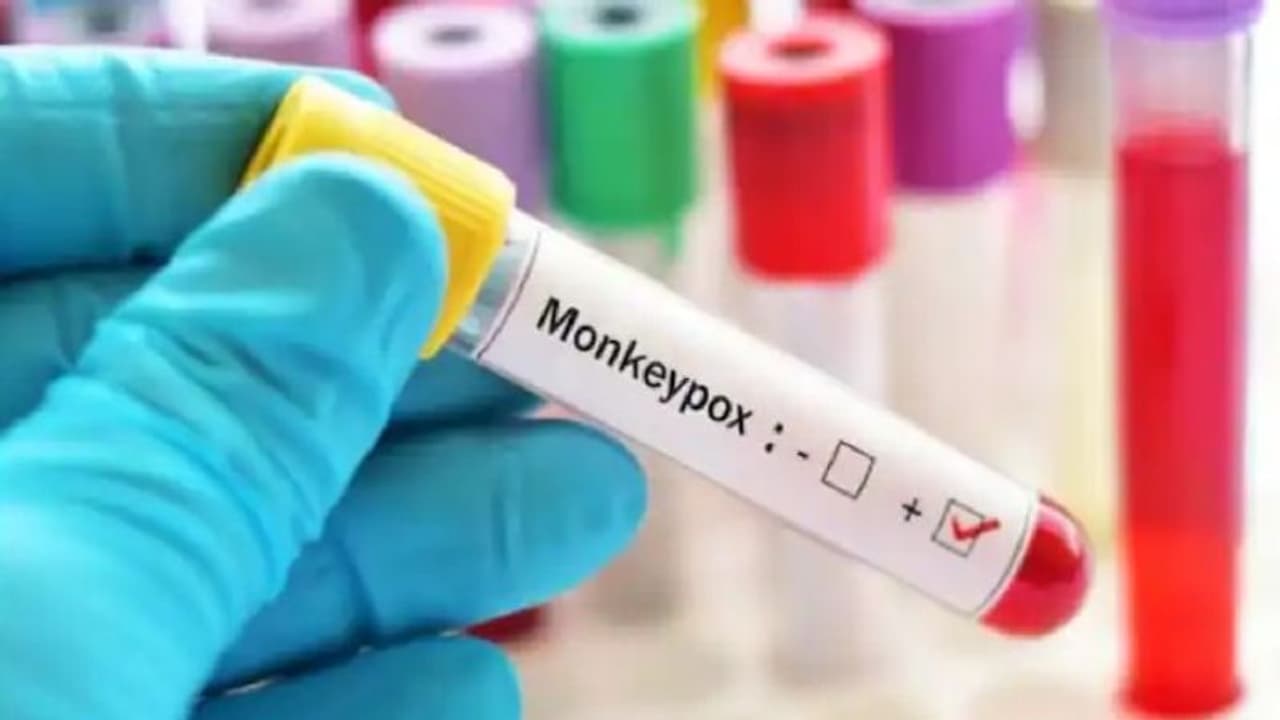 മങ്കിപോക്സ് രോഗലക്ഷണം: കണ്ണൂരില്‍ ഏഴ് വയസുകാരി ചികിത്സയില്‍ | A Seven ...