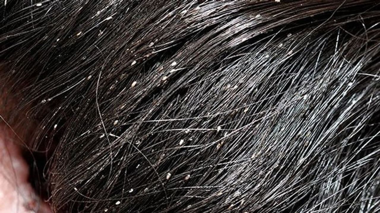 Lice Infestation: பேன் தொல்லையால் அவதியா? இதோ ஒருசில எளிய டிப்ஸ் ...