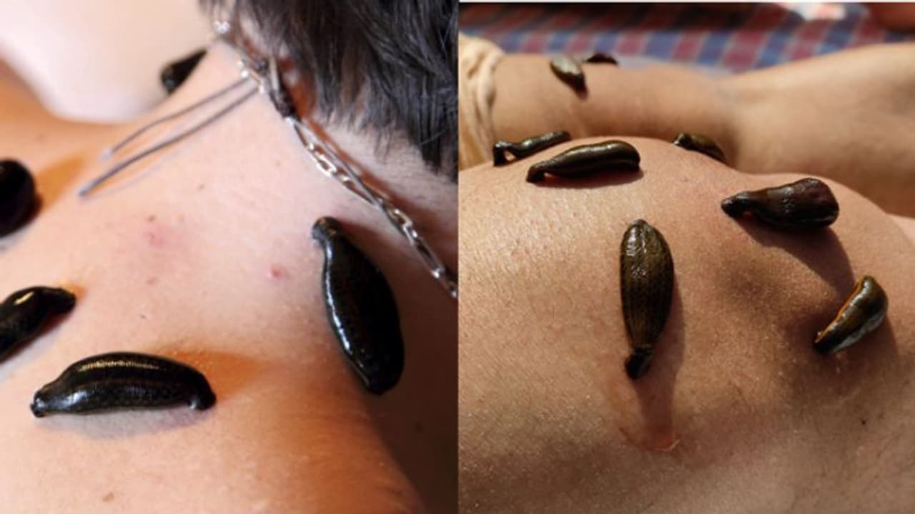 അട്ട തെറാപ്പിയെ പേടിക്കണമോ ? ഏതൊക്കെ രോ ഗങ്ങൾ മാറ്റും ? | All You Need ...