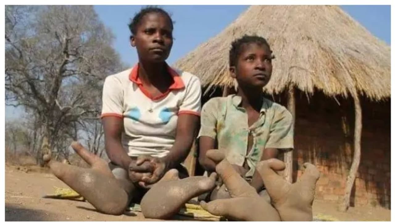 Zimbabwe Vadoma People : ಮುಖ ಮನುಷ್ಯರಂತೆ.. ಕಾಲು ಆಸ್ಟ್ರಿಚ್ ನಂತೆ ...