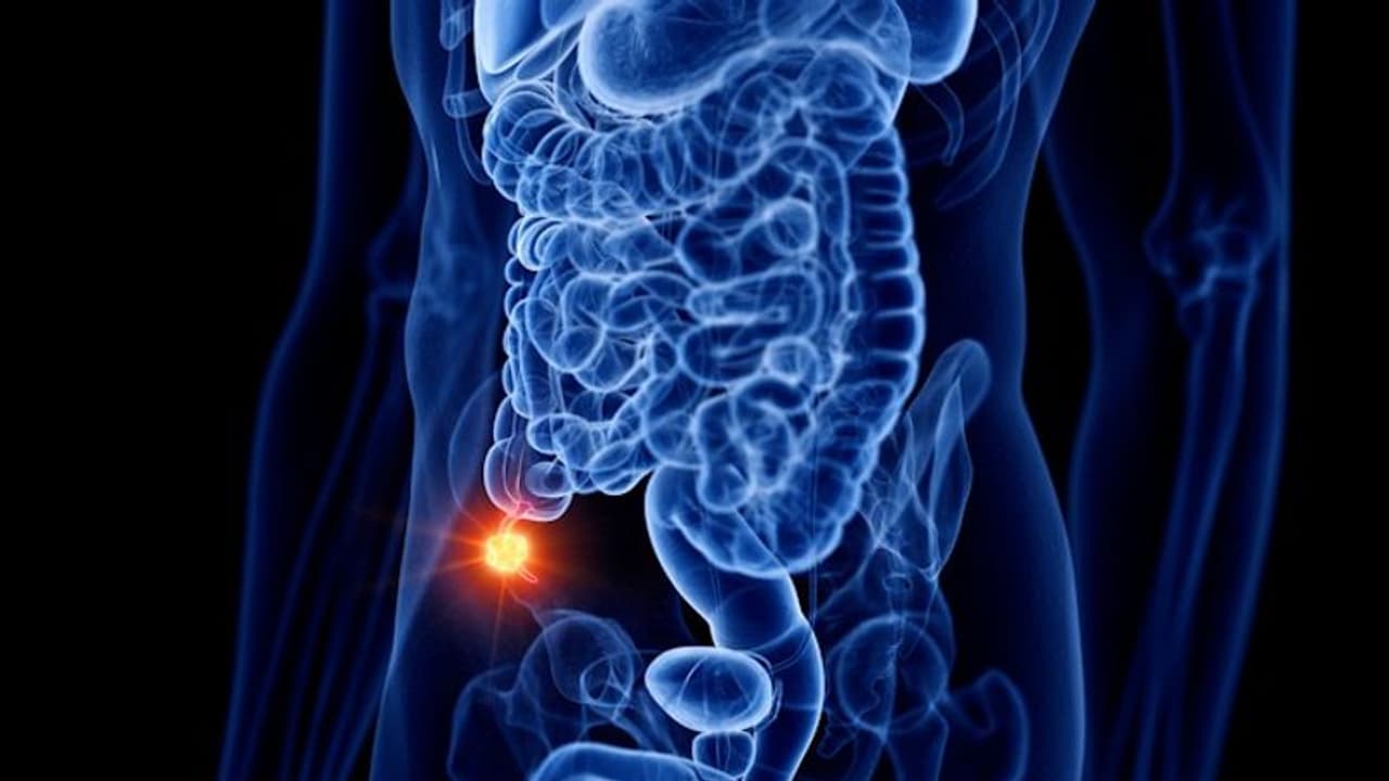 What is appendix cancer? Know the common symptoms and recognise the ...