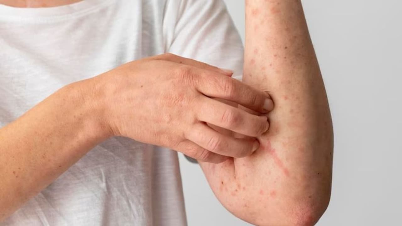 chickenpox alert പൊള്ളുന്ന ചൂടാണ്, ചിക്കന്‍പോക്‌സിനെതിരെ ജാഗ്രത വേണം ...