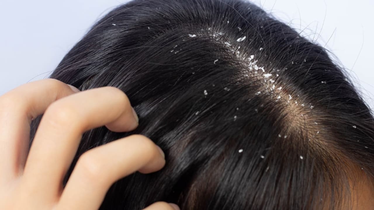Dandruff : பொடுகு தொல்லையை ஒழிக்க முடியலயா? முதல்ல இந்த வைட்டமின் ...
