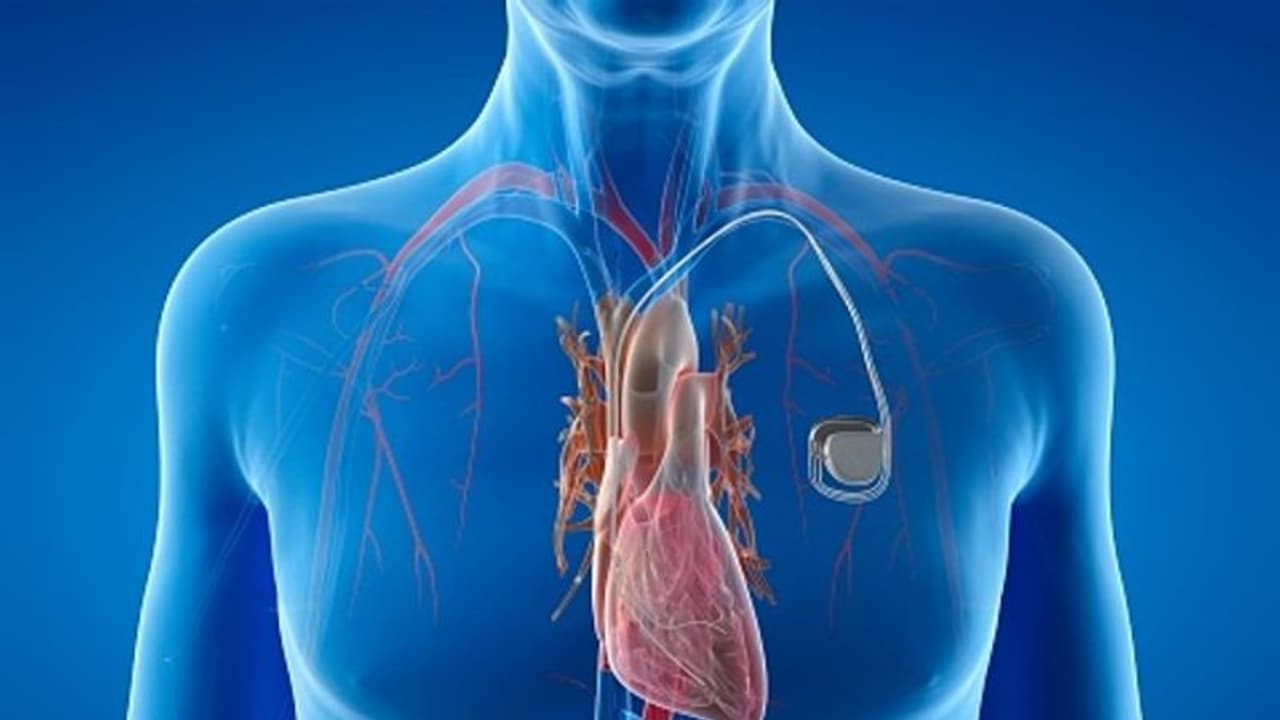 Breakthrough surgery: In a first, 'smallest' pacemaker successfully ...