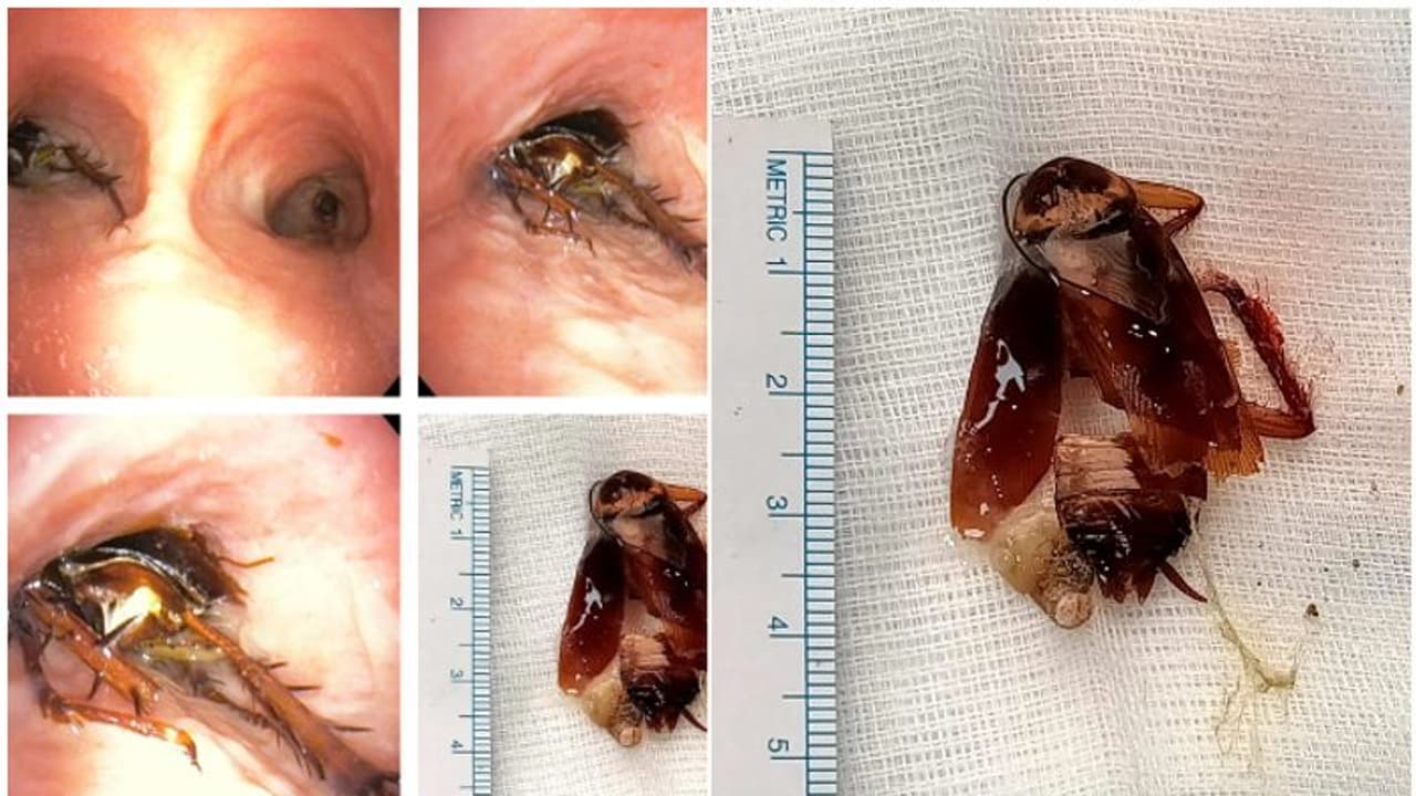 Kerala: 4 cm long cockroach removed from lungs of 55-year-old man in ...