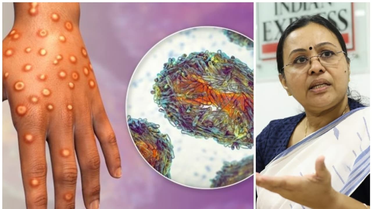 m pox disease confirmed in malappram kerala alert for expats കേരളത്തി ...