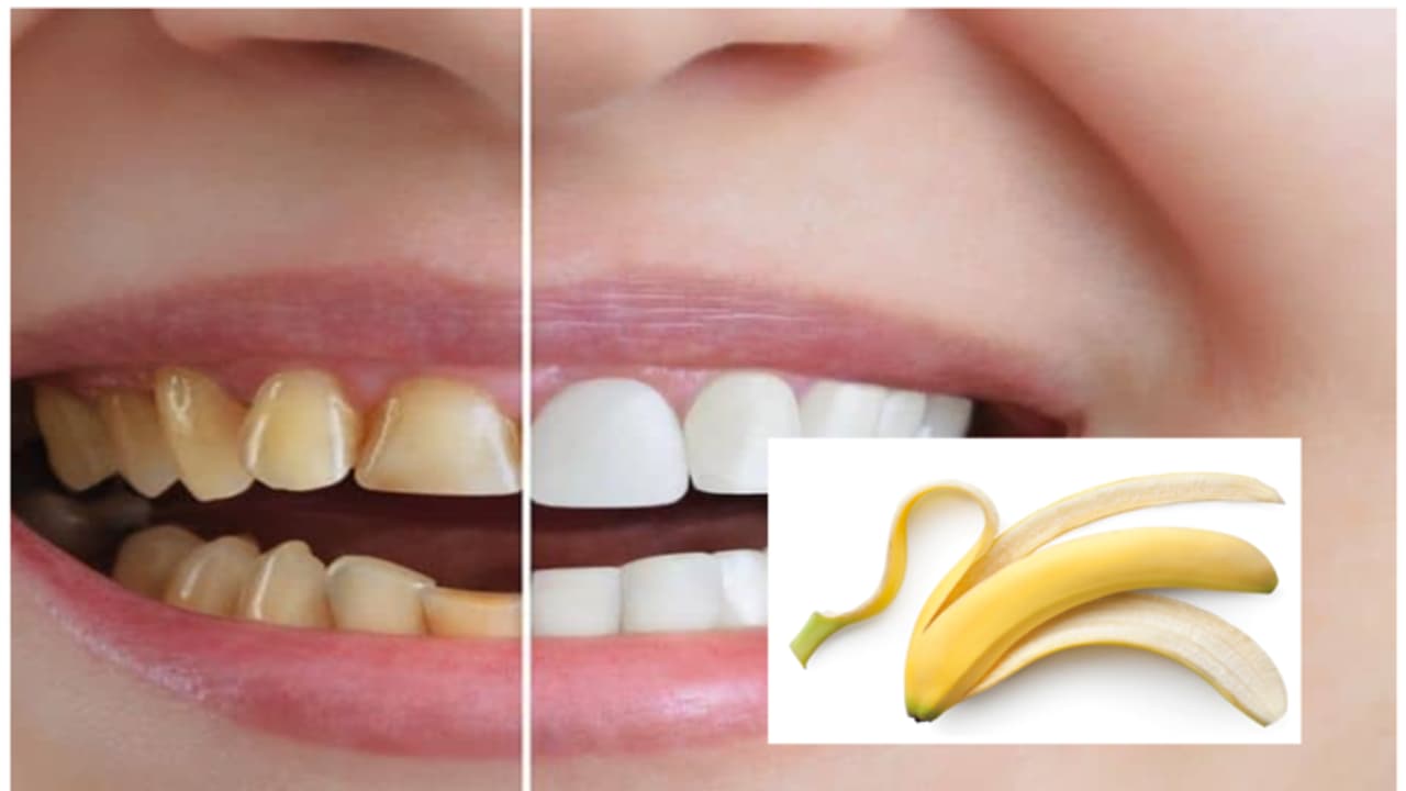 Do Banana Peels Really Whiten Teeth? Here’s What Science Says | Asianet ...