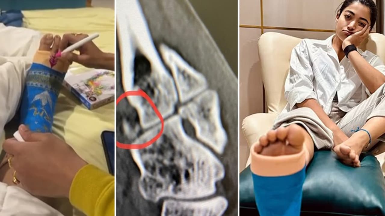 ‘Miss standing on my feet,' says Rashmika Mandanna with 3 fractures and ...