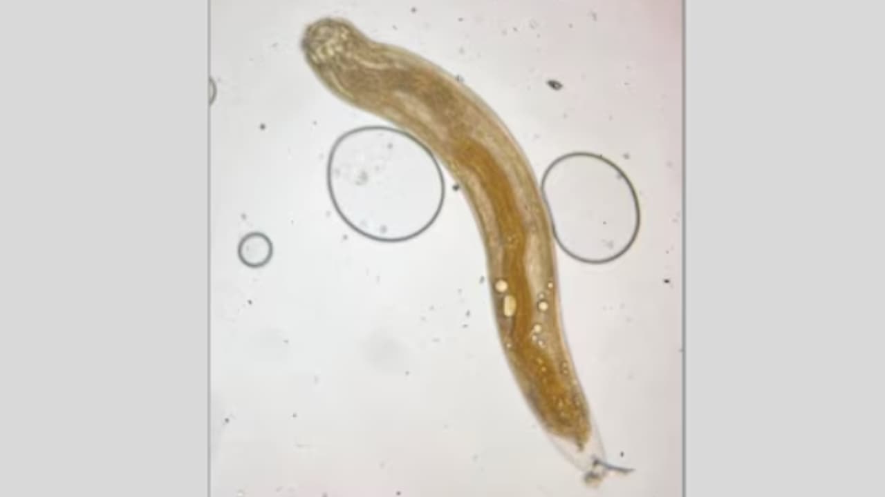 removed one inch live worm from eye in complex surgery കാഴ്ച മങ്ങുന്നു ...