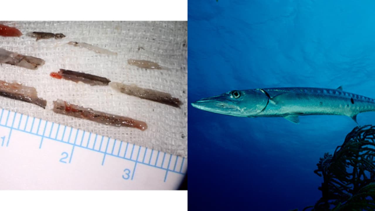 Parts of Barracuda tooth removed from spinal cord of 32 year old man ...