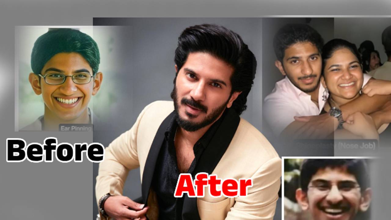 వాటిని ప్లాస్టిక్ సర్జరీ చేయించుకున్న దుల్కర్ సల్మాన్.. సర్జరీకి ముందు ...