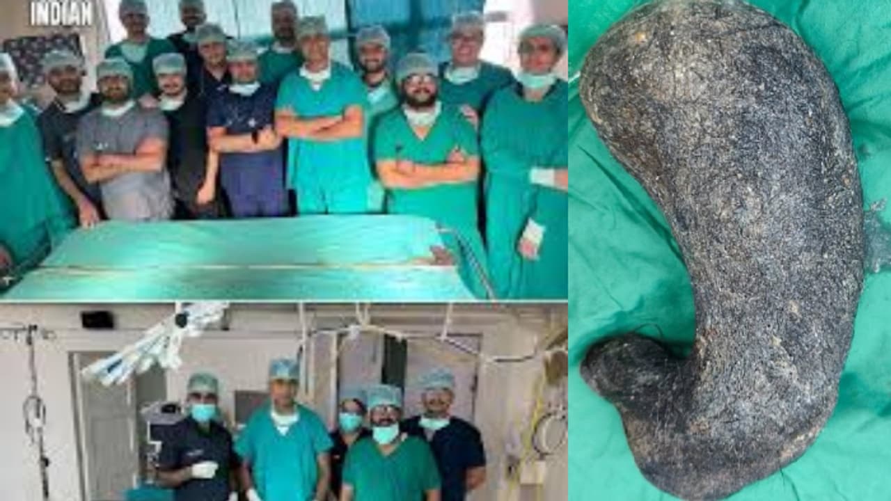 Giant hairball removed from 14-year-old's stomach in rare surgery: അപൂ ...