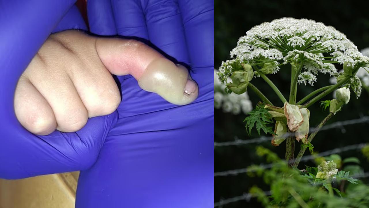 exposed to giant hogweed toddler suffer severe burn injury; ഡേ കെയറി ...