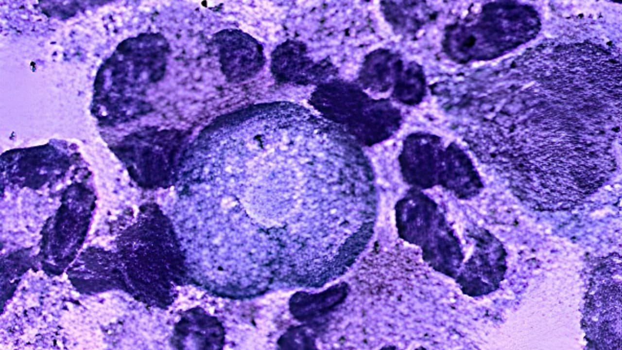 Brain Eating Amoeba & Fever Alert in Chennai! அச்சுறுத்தும் மூளையை ...