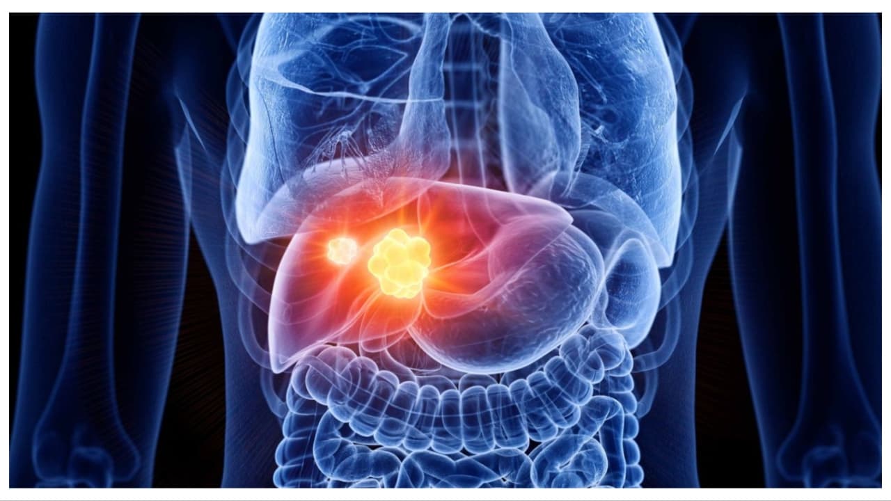 Five Early Warning Signs of Liver Cancer You Should Never Ignore ...