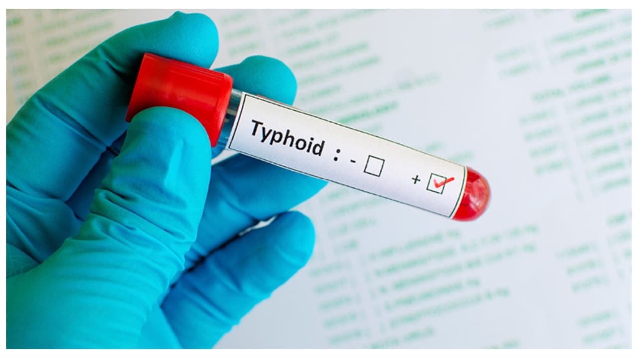Typhoid Fever: Seven Early Symptoms the Body Shows Before the Infection ...