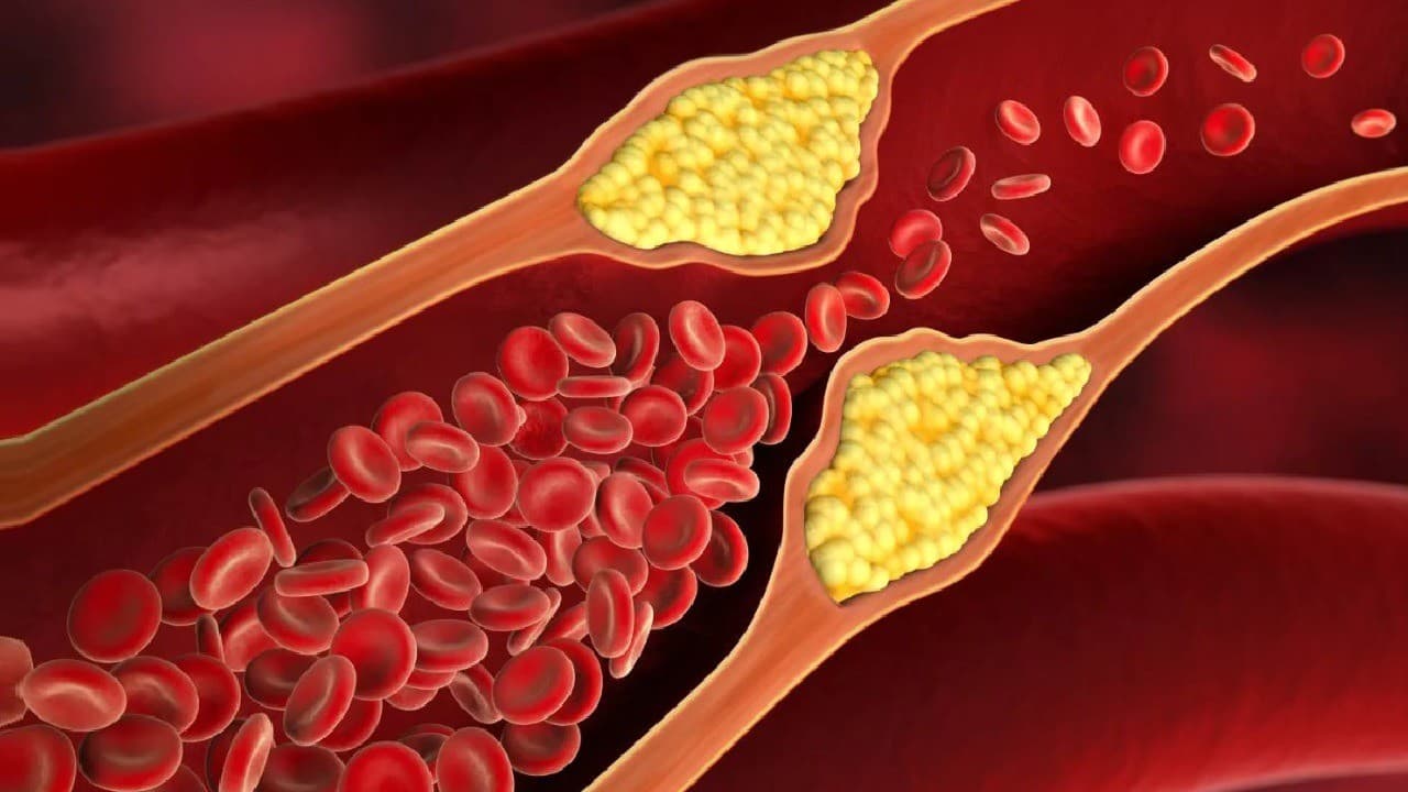 Cholesterol Control: 7 Simple Lifestyle Tweaks to Keep Your Heart Happy ...