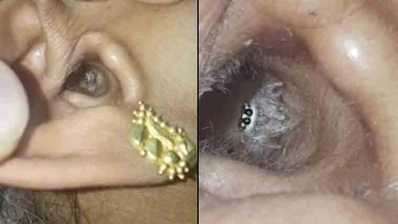 Bengaluru woman shocked to see spider crawling out of her ear [Video ...