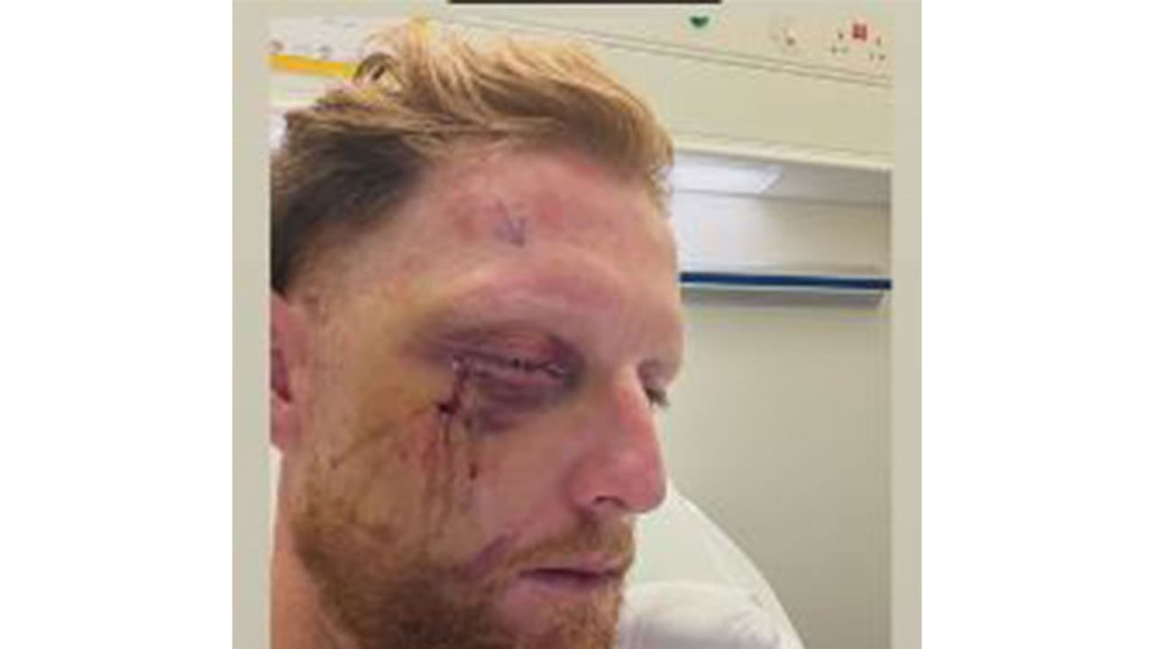 Ben Stokes undergoes successful facial surgery after cricket ball ...